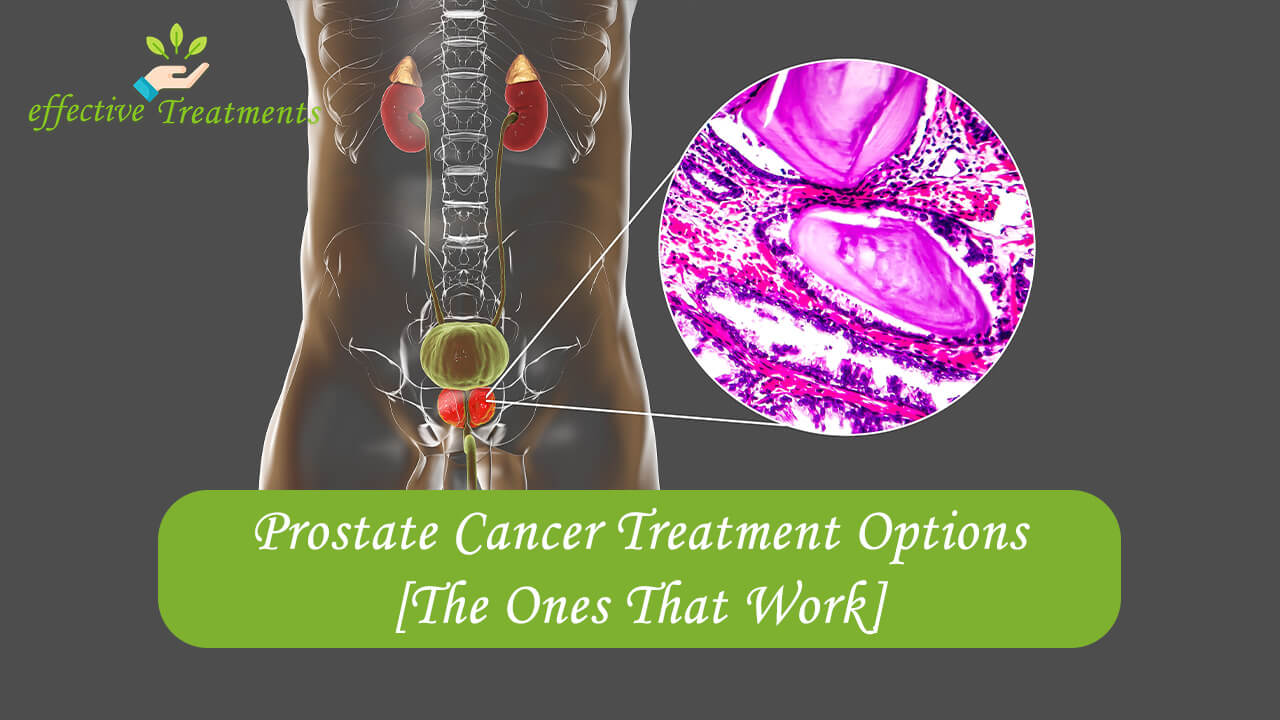Prostate Cancer Treatment Options [the Ones That Work]